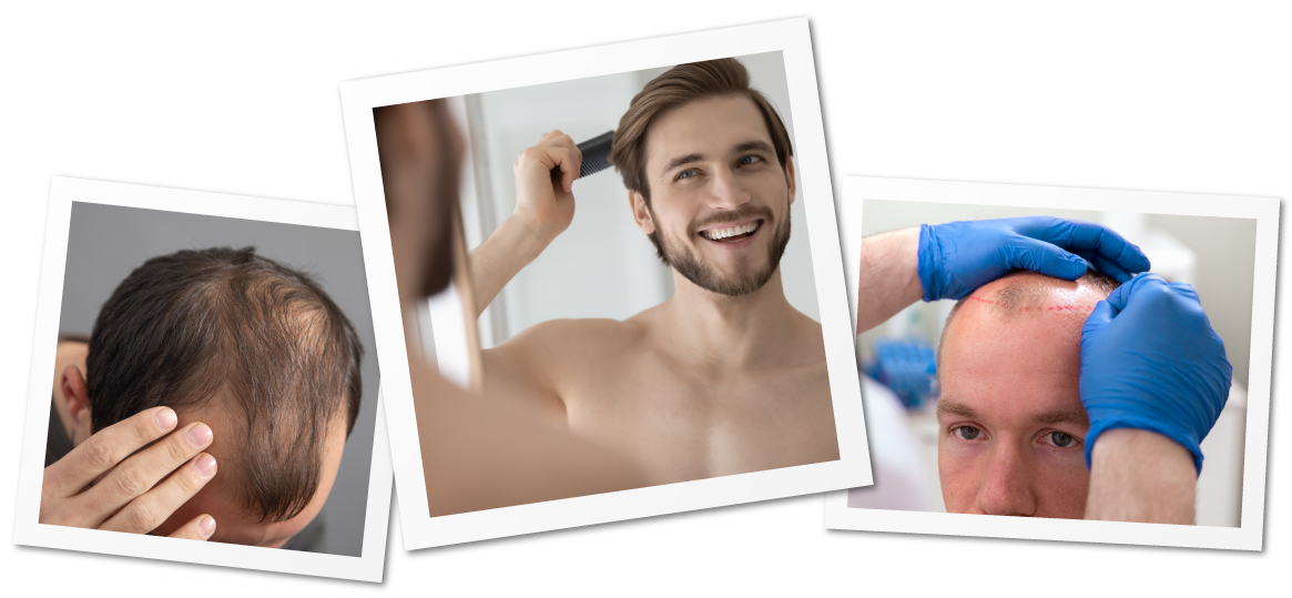 Sapphire Hair Transplant In Turkey Mek Clinic